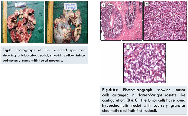 Primary Pulmonary Primitive Neuroectodermal Tumor With Cns Metastasis